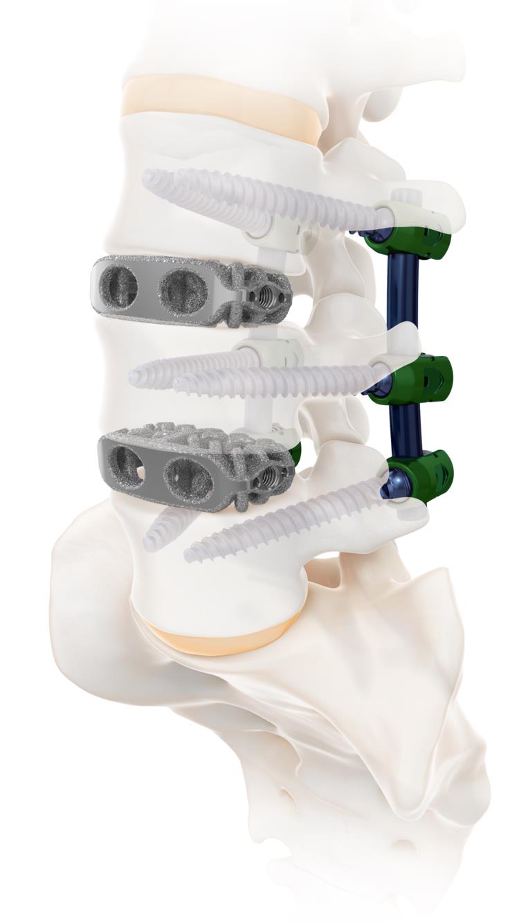 Spira - LLIF - Lumbar - Titanium Open Architecture Implant by ...