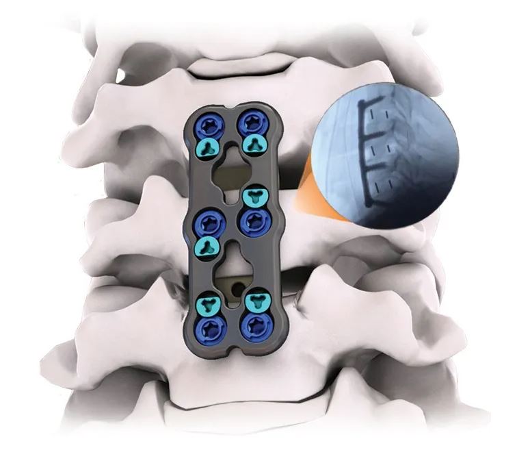 GRUVE - Cervical - Anterior Cervical Plate System by Life ...