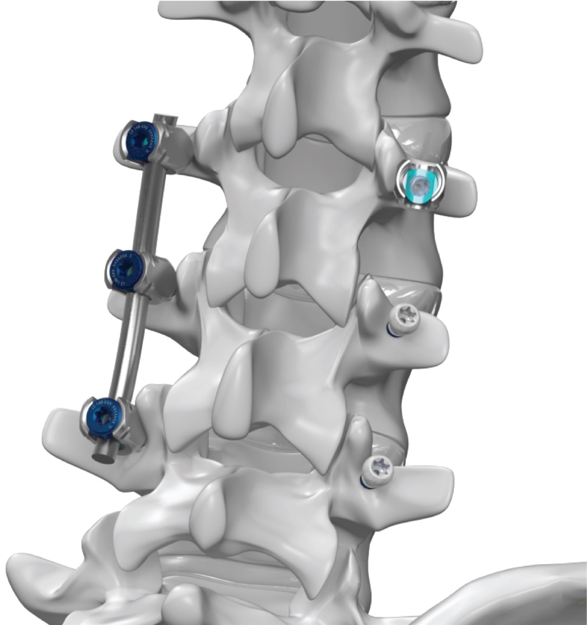 Life Spine - ARx - Thoracolumbar - Spinal Fixation System by ...