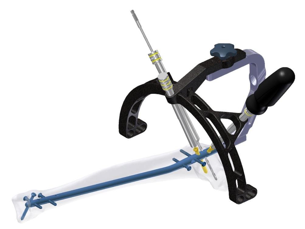 HIMALAYA - Intramedullary Nails - Expert Tibia Nailing System By ...