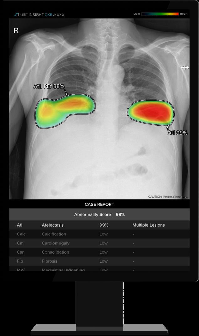 Lunit INSIGHT CXR AI Solution For Chest X-Ray