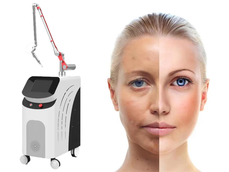 The effects of picosecond laser technology treatment spots