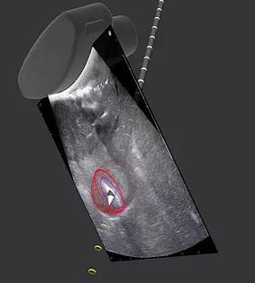 Aim 3D Needle Navigation Software For Simpler, Safer And More-Effective ...