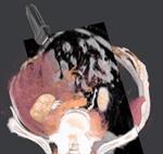 Spotlight 3D Navigation with CT-Ultrasound Fusion