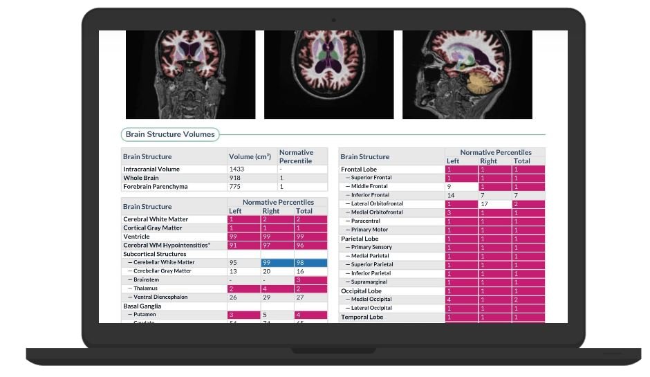 Neuroquant TBA Triage Brain Atrophy Report Software