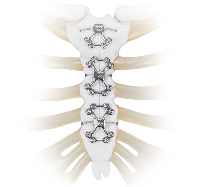 Sternalock XP Rigid Fixation System