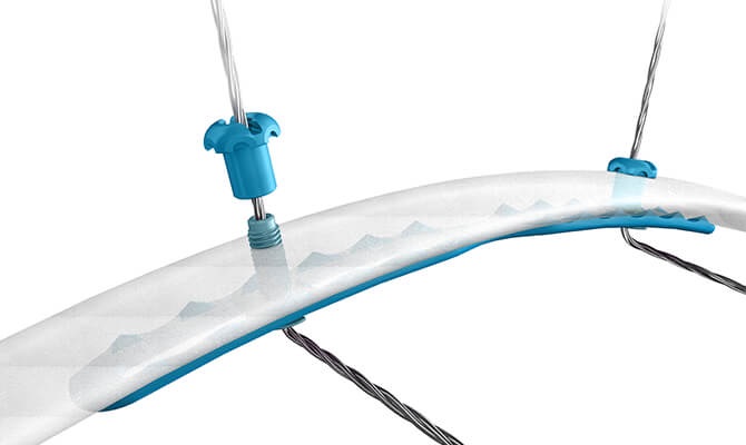 RibFix Advantage - Rib Fixation - Intrathoracic Fixation ...