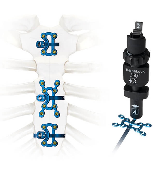Sternalock 360 Sternal Closure Sternal Rigid Fixation Sternal