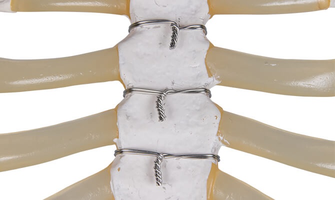 Doublewire Sternal Closure System