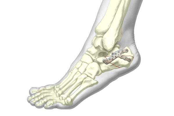 TriMed - Lower Extremity - Calcaneal Fracture Fixation