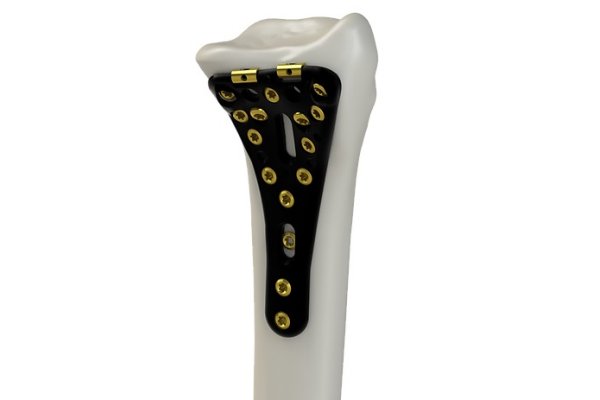 Mcginley Orthopedics - Lever Action Plate System By Mcginley Orthopedics