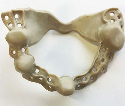 Drake - PEEK Dental Implants By Genesis Medical Plastics