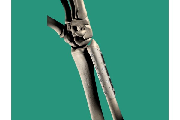 Inion FreedomPlate - Fracture Fixation System by Inion Oy