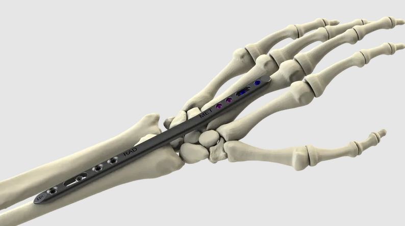 OIC - DSP - Implant - Plates And Screws - Dorsal Spanning Plate By The ...