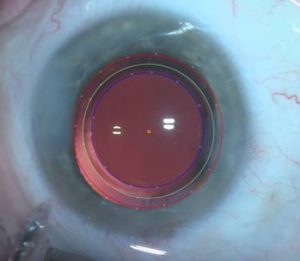 CAPSULASER - Selective Laser Capsulotomy System by ...