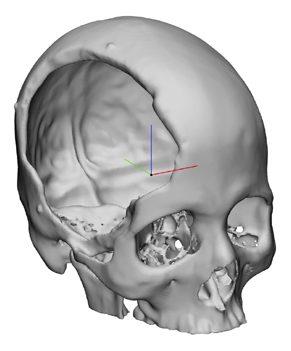 Matrix - Customized Implants - Customized Implants by Matrix ...