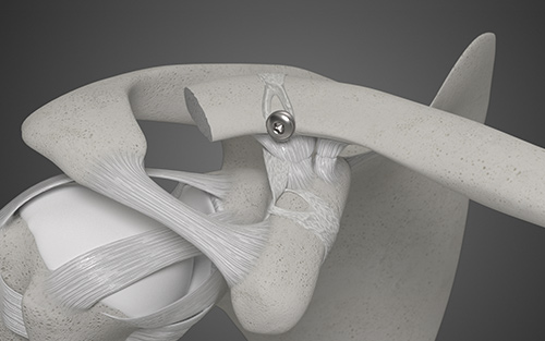 LockDown - Orthopedic - Upper Limb - ACJ Ligament Device by ...