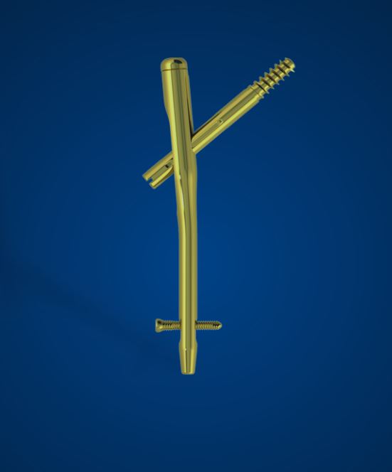 EBA One - Trauma & Extremities - Single Lag Screw Nailing ...