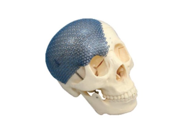 Titanium Mesh System For Skull Reconstruction