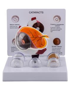 Pro-Health - PH14-002 - Pathological Model - Oversized Human Cataract ...
