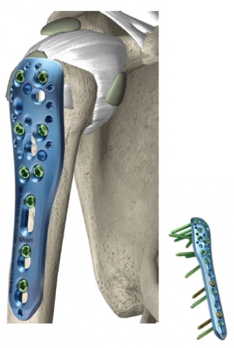 Sorath - Trauma - Upper Extremities - BCP Proximal Humerus ...