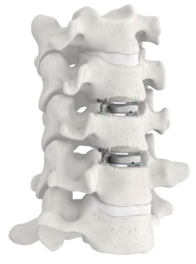 Mobi-C - Spine - Cervical Solutions - Cervical Disc By Zimvie Inc.