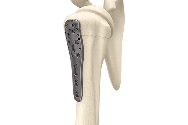 Miraclus ASLP Proximal Humerus Plate System